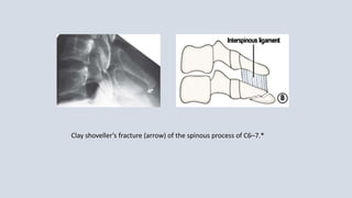 Cervical spine trauma | PPTX