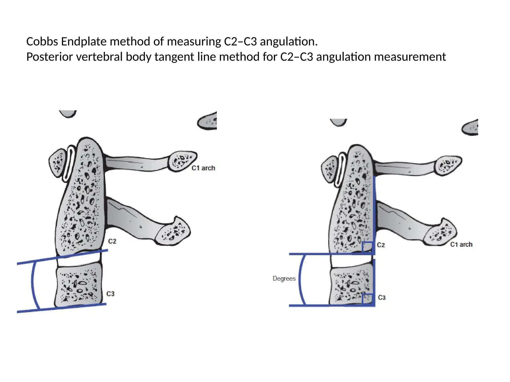 Cervical spine injuries - Upper nd Lower | PPTX