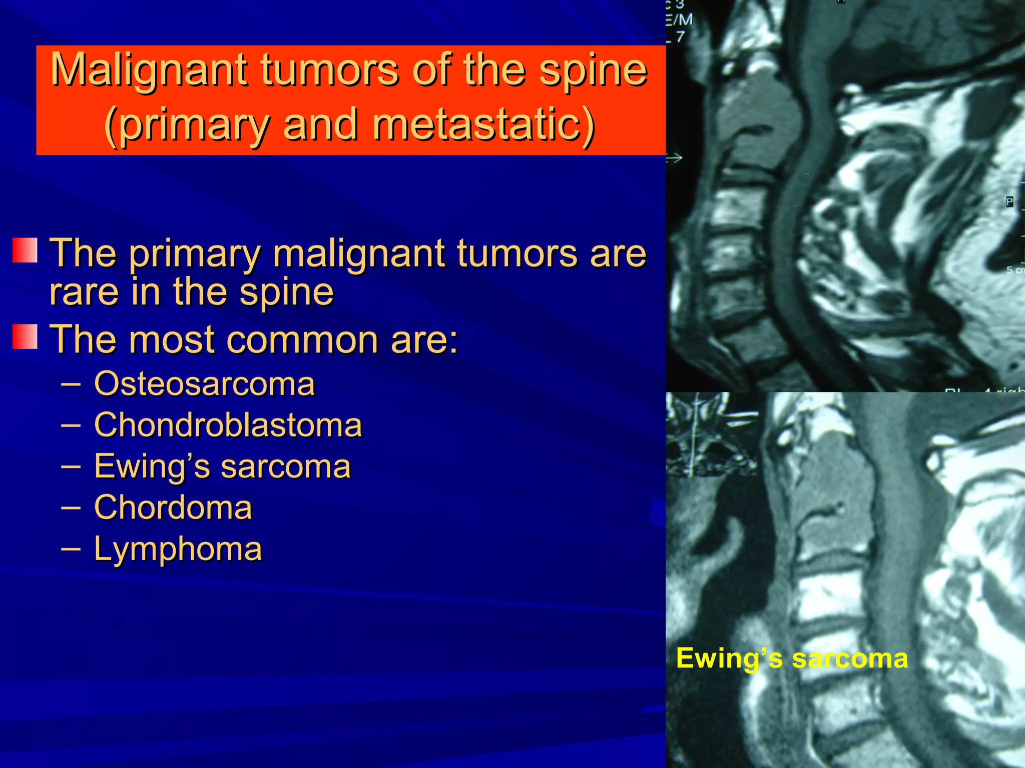 Malignant Cervical Spine Tumors Operative treatment | PPT