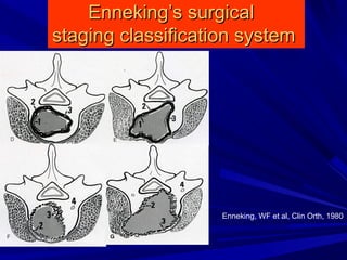 Malignant Cervical Spine Tumors Operative treatment | PPT