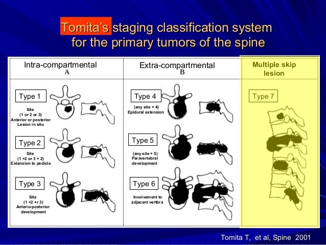 Malignant Cervical Spine Tumors Operative treatment