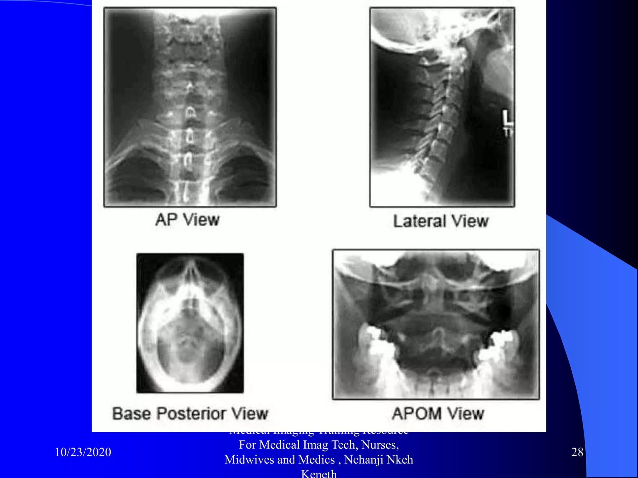 Cervical spine x ray and pathologies radiology training resource nchanji nkeh keneth | PDF
