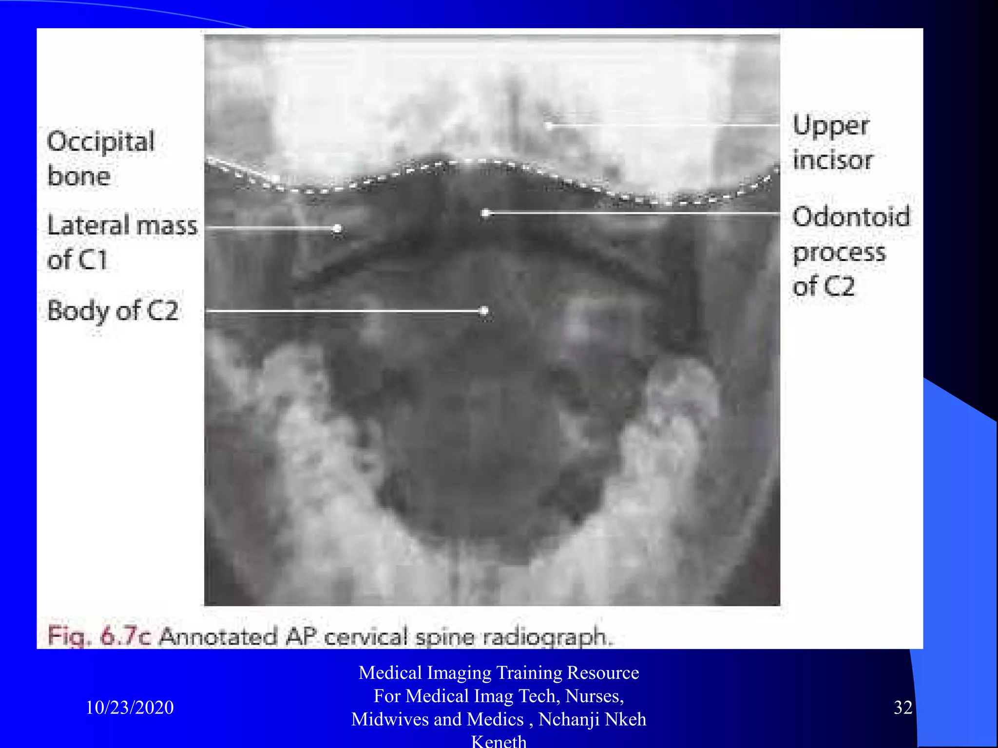 Cervical spine x ray and pathologies radiology training resource nchanji nkeh keneth | PDF