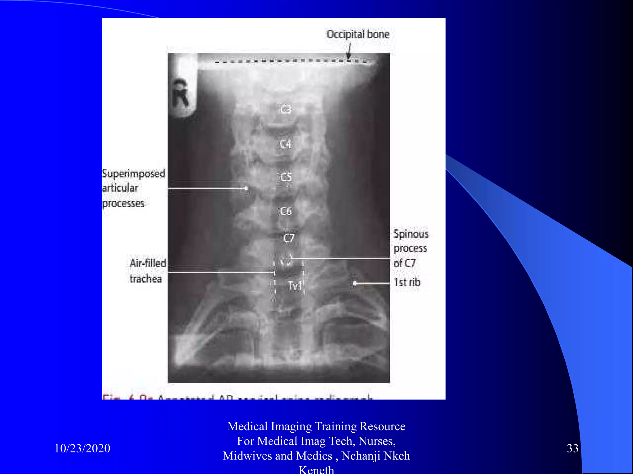 Cervical spine x ray and pathologies radiology training resource ...