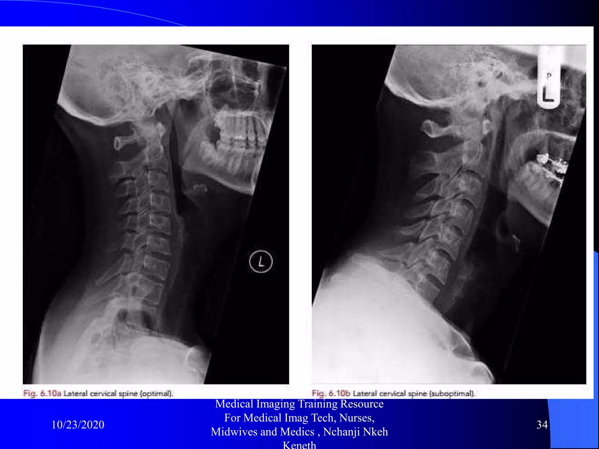 Cervical spine x ray and pathologies radiology training resource ...
