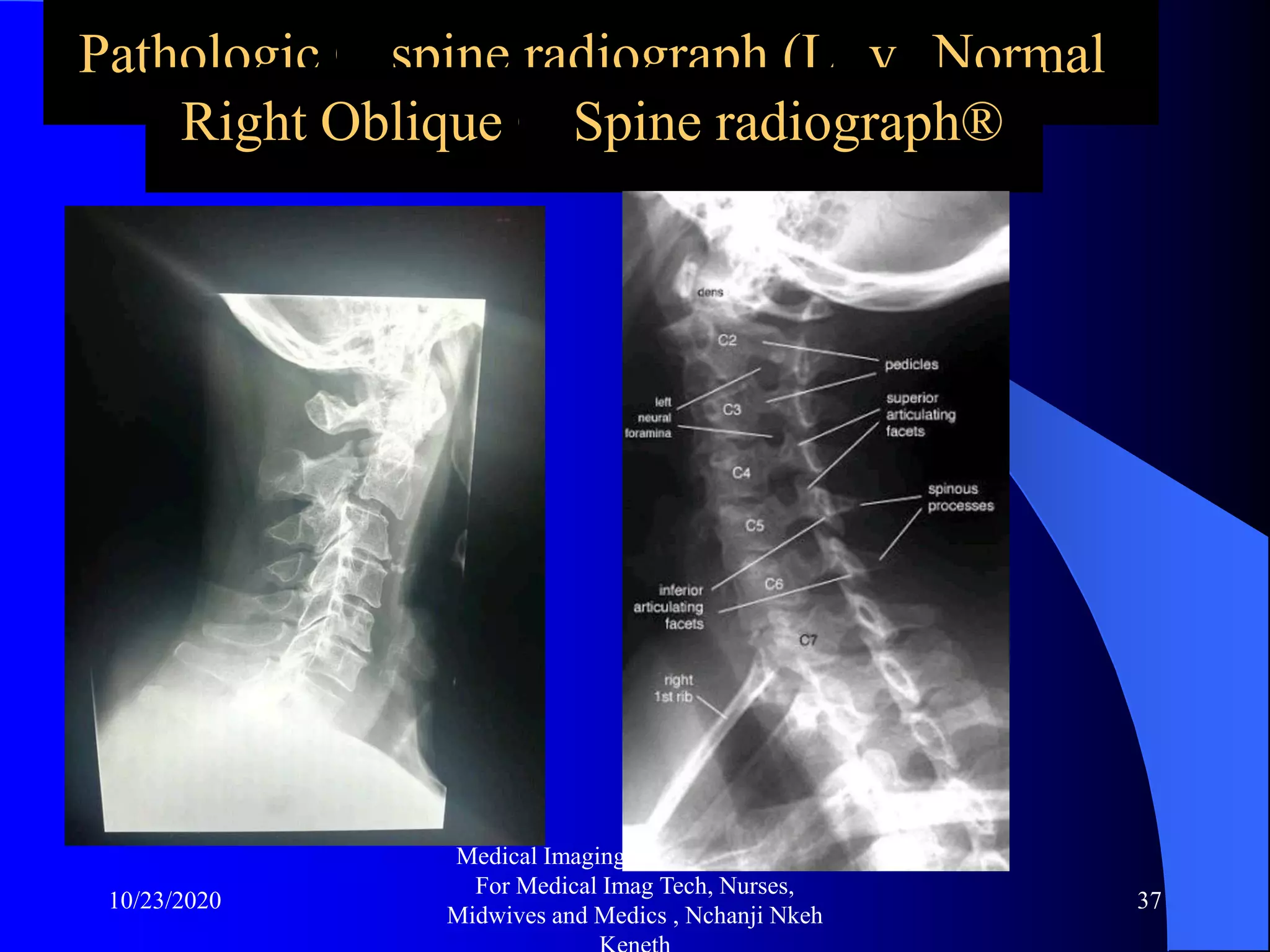 Cervical spine x ray and pathologies radiology training resource ...