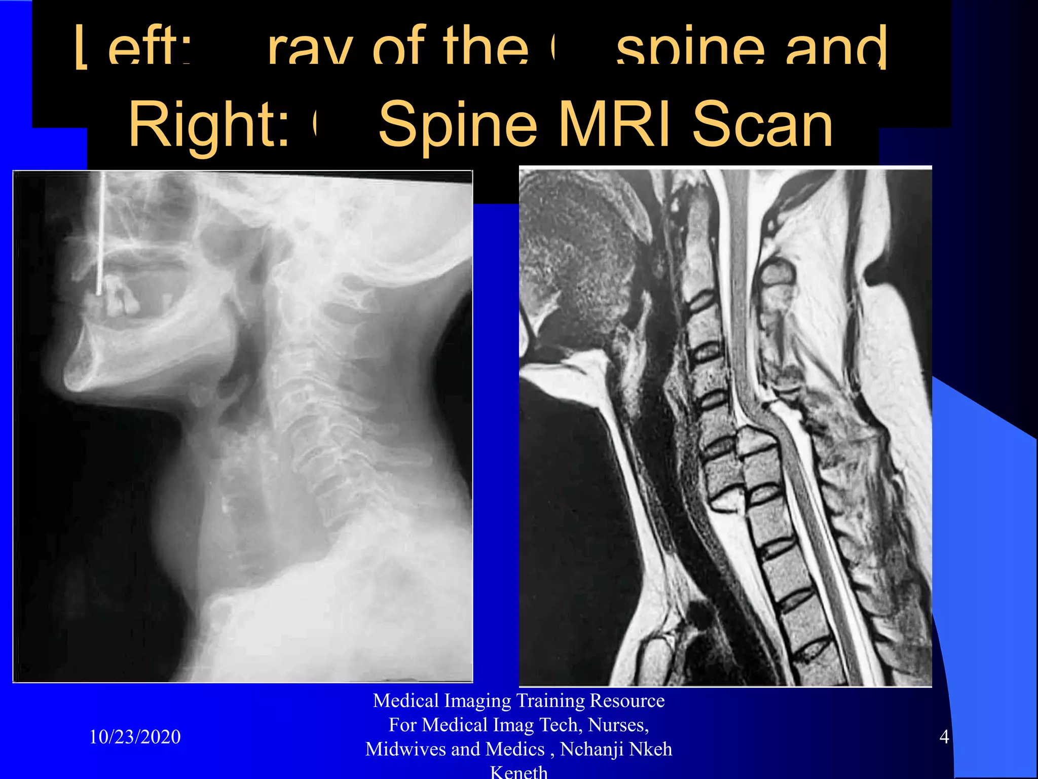 Cervical spine x ray and pathologies radiology training resource ...