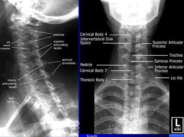Cervical spine x ray and pathologies radiology training resource ...