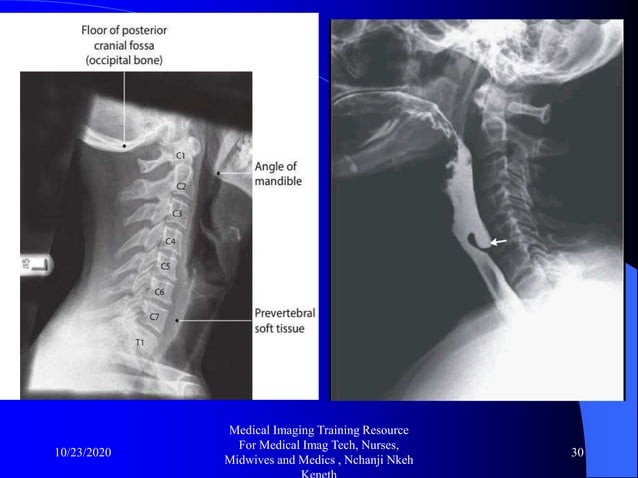 Cervical spine x ray and pathologies radiology training resource ...