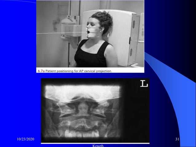 Cervical spine x ray and pathologies radiology training resource ...