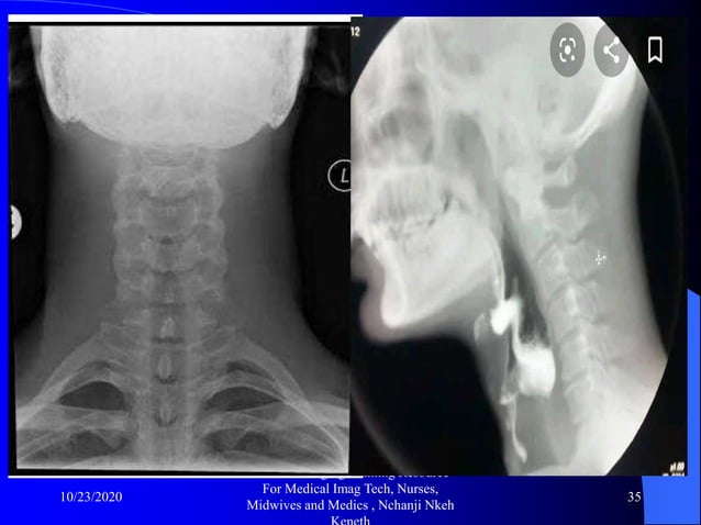 Cervical spine x ray and pathologies radiology training resource ...
