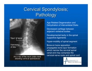 Cervical spondylosis | PDF