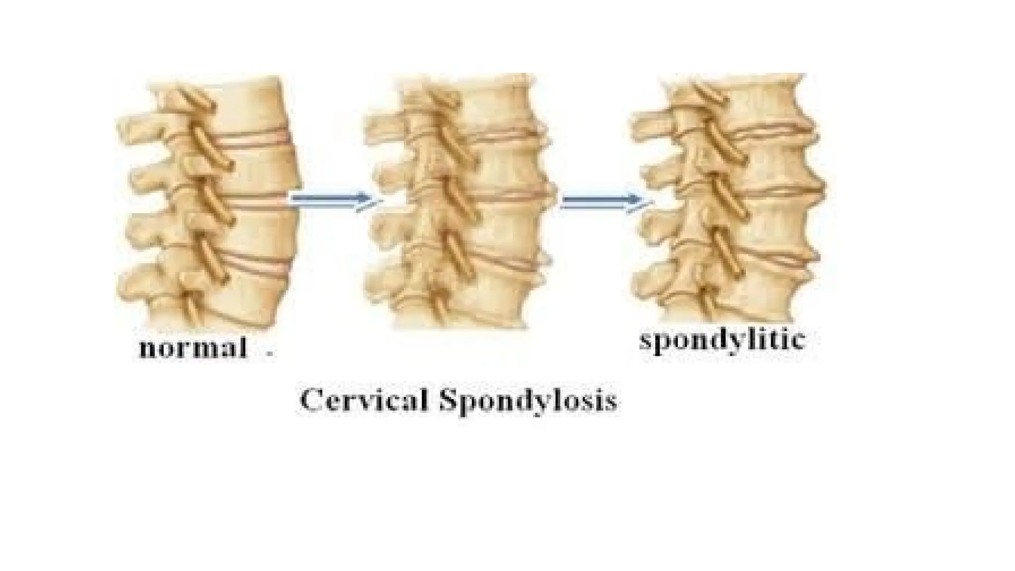 Cervical spondylosis Degenerative cervical spine | PPTX