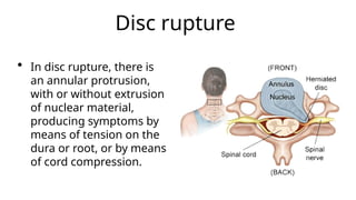Cervical Spondylosis and associated conditions | PPT