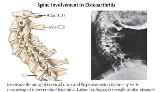 Cervical Spondylosis and associated conditions | PPTX