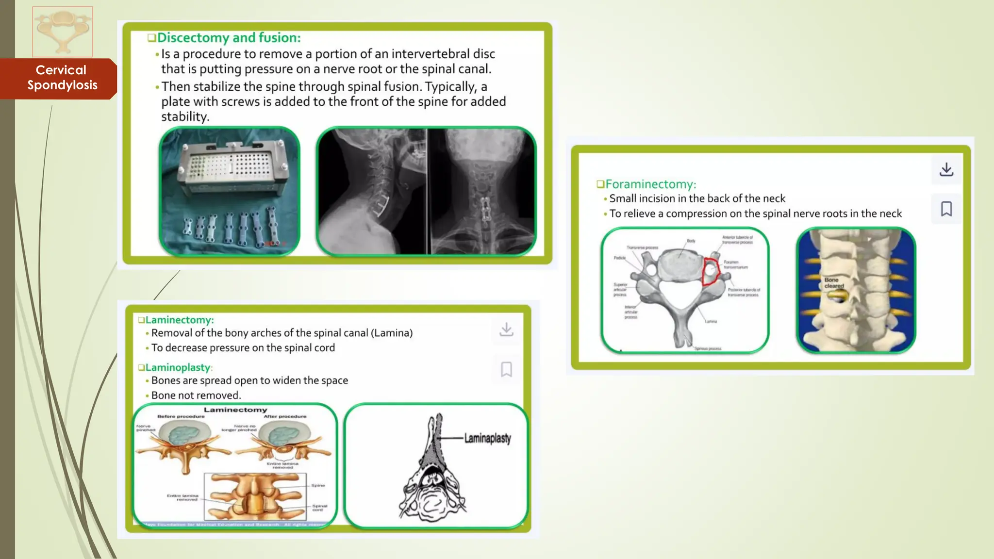 Cervical Spondylosis - An Overview of Degenerative Cervical Spine ...