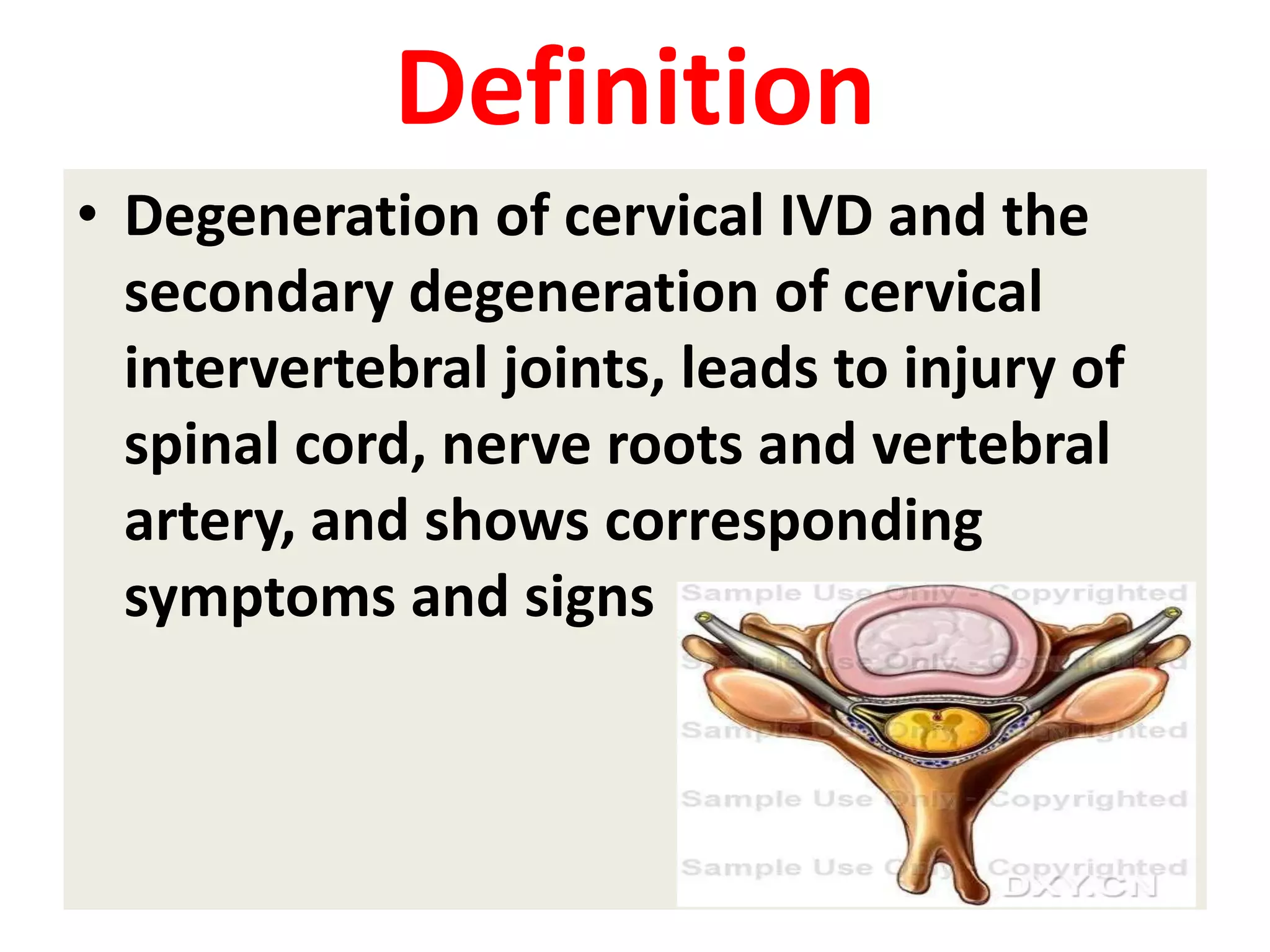 Cervical Spondylosis Syndrome | PPTX