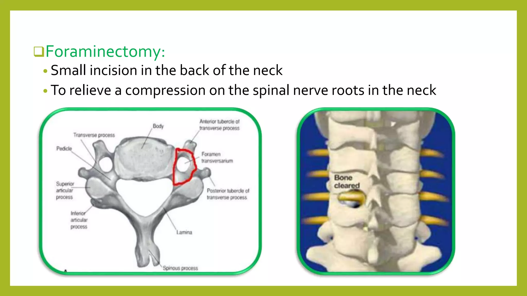 Cervical Spondylosis - Management | PPTX