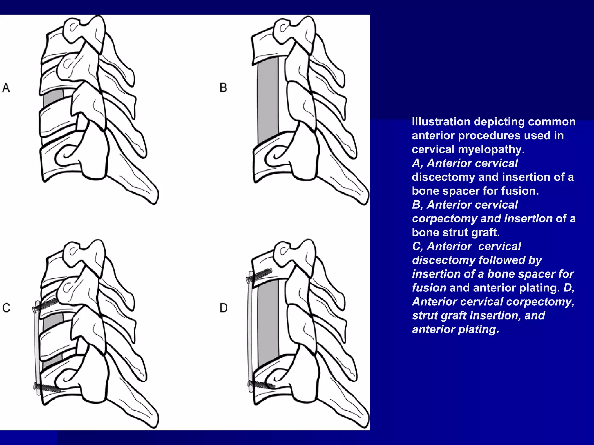 Cervical spondylotic myelopathy | PDF