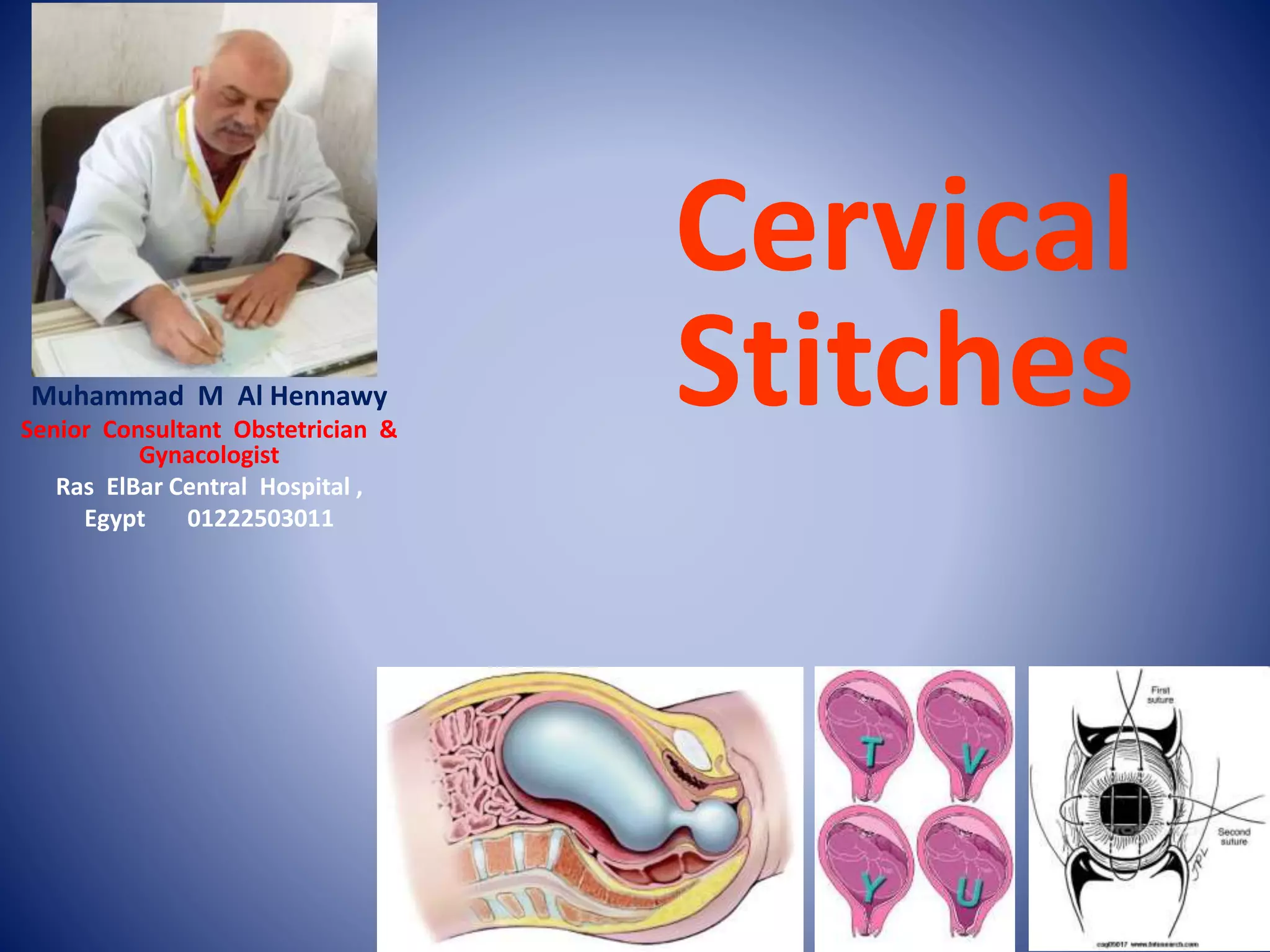 Cervical stitches | PPTX