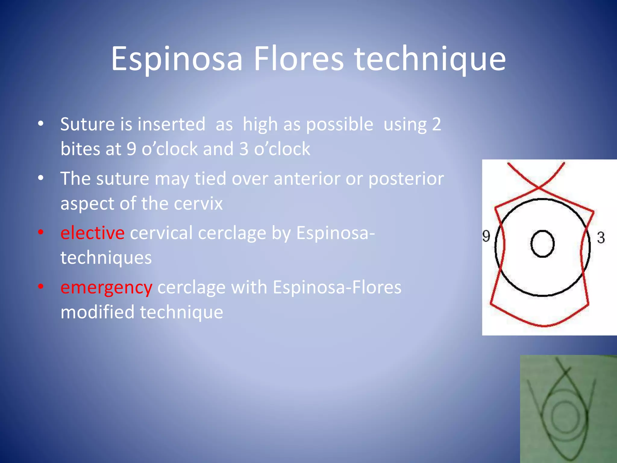 Cervical stitches | PPTX