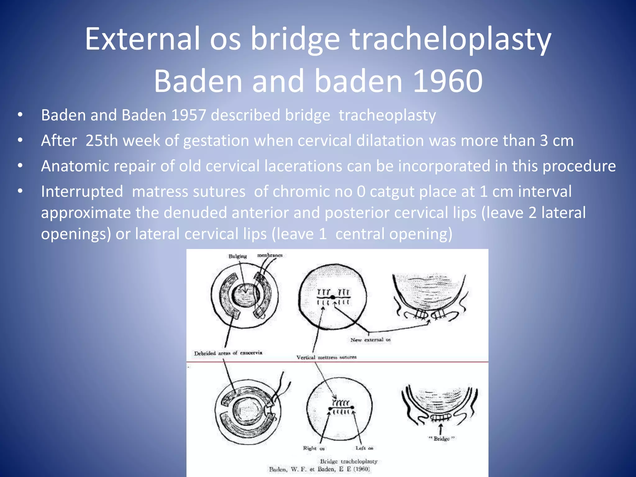 Cervical stitches | PPTX