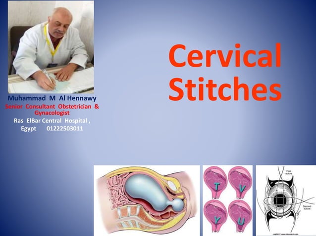 Cervical stitches | PPTX | Pregnancy | Reproductive Health