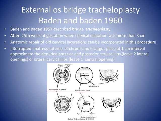 Cervical stitches | PPTX | Pregnancy | Reproductive Health