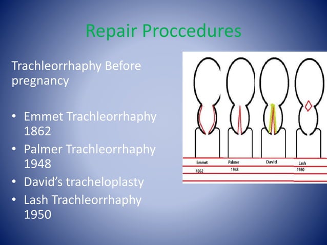 Cervical stitches | PPT