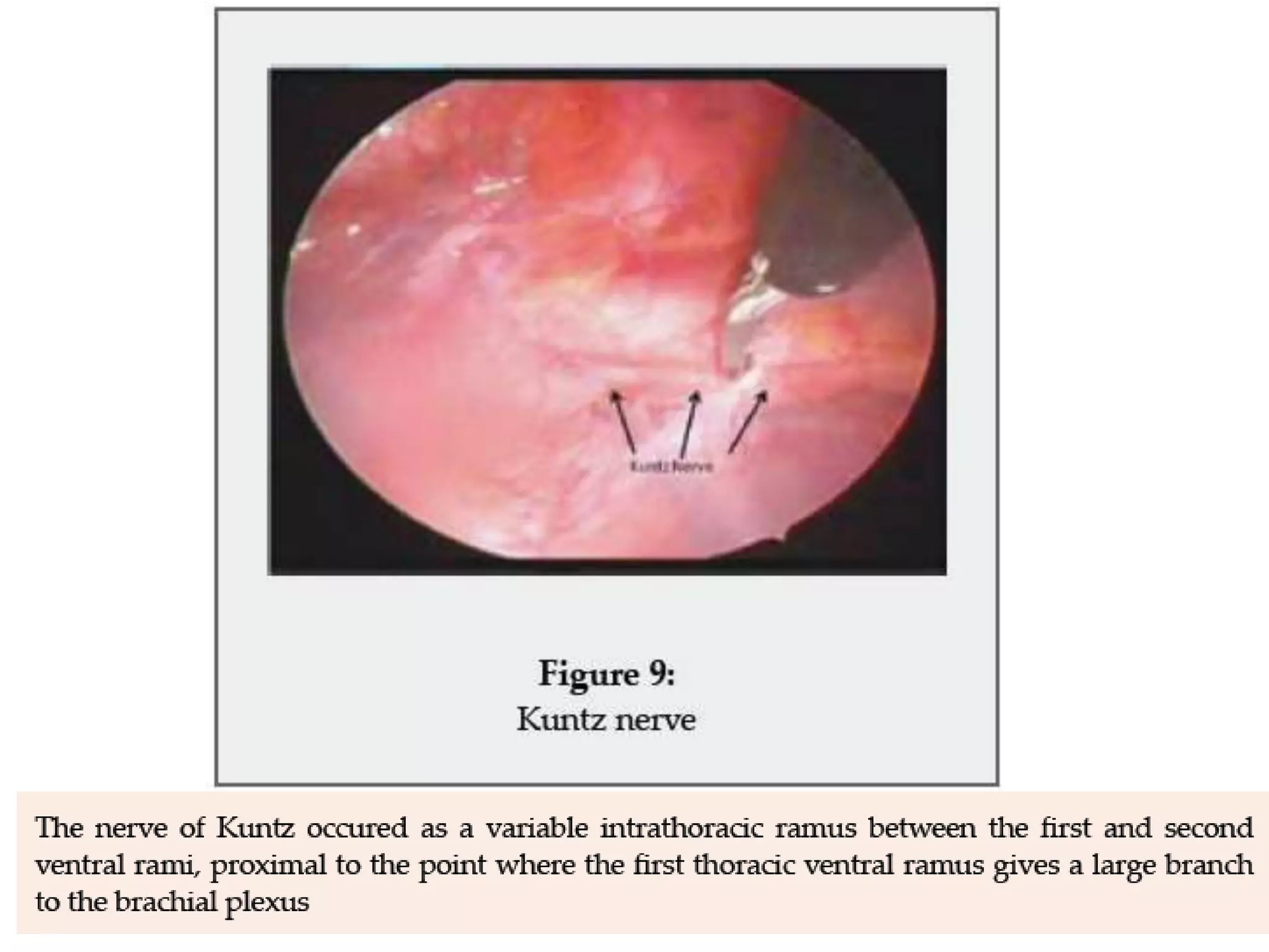 Cervical sympathectomy | PPTX