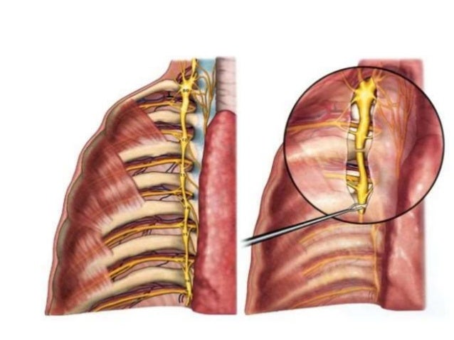 Cervical sympathectomy