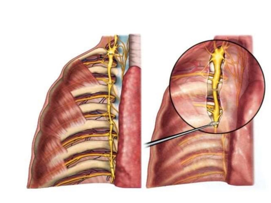 Cervical sympathectomy