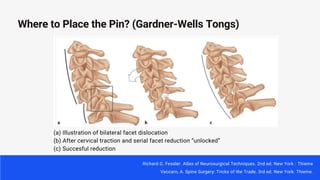 Cervical Traction.pptx