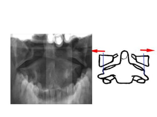 Cervical trauma | PPTX