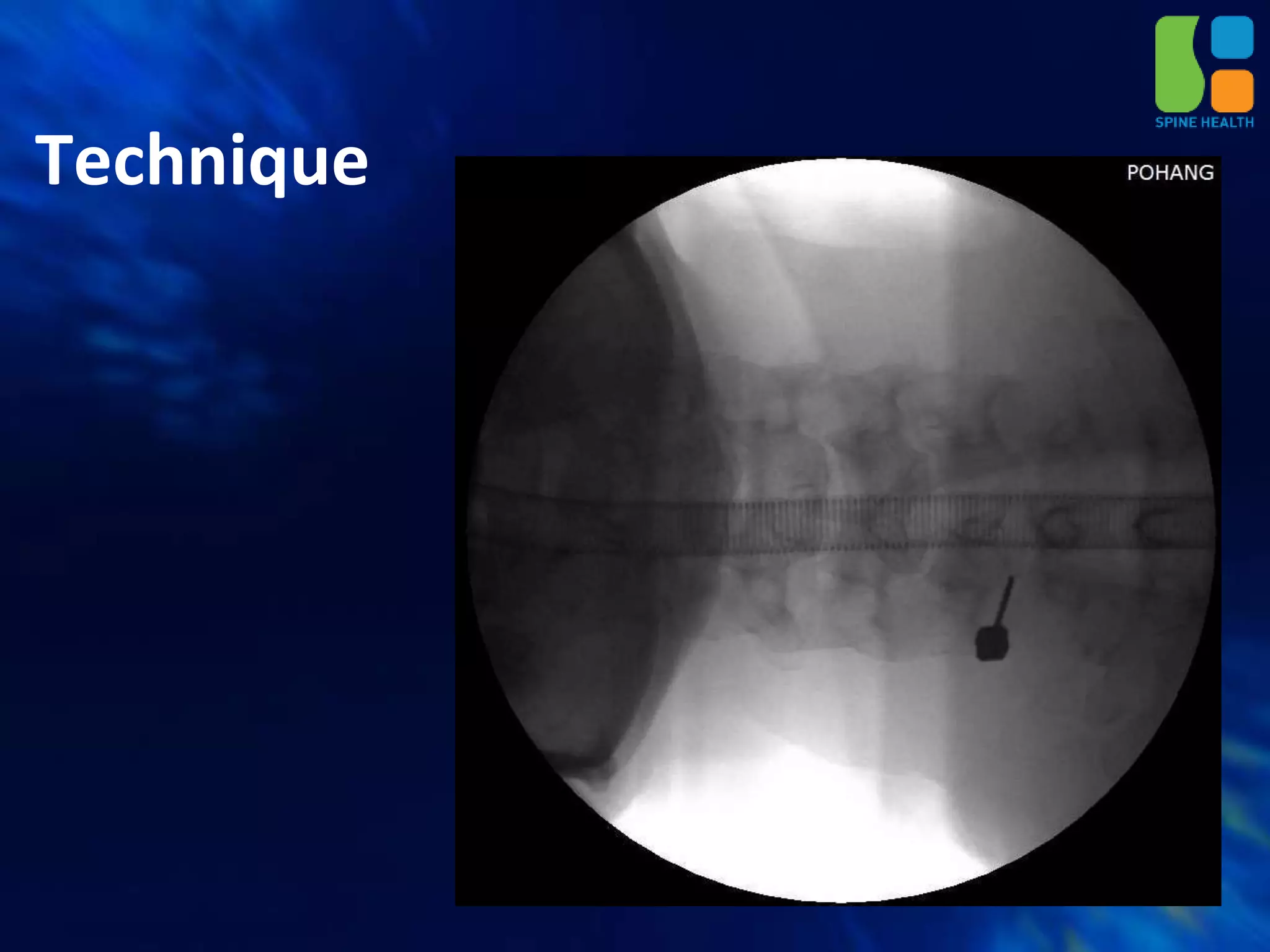 Unilateral Biportal Endoscopic Posterior Cervical Laminectomy and ...