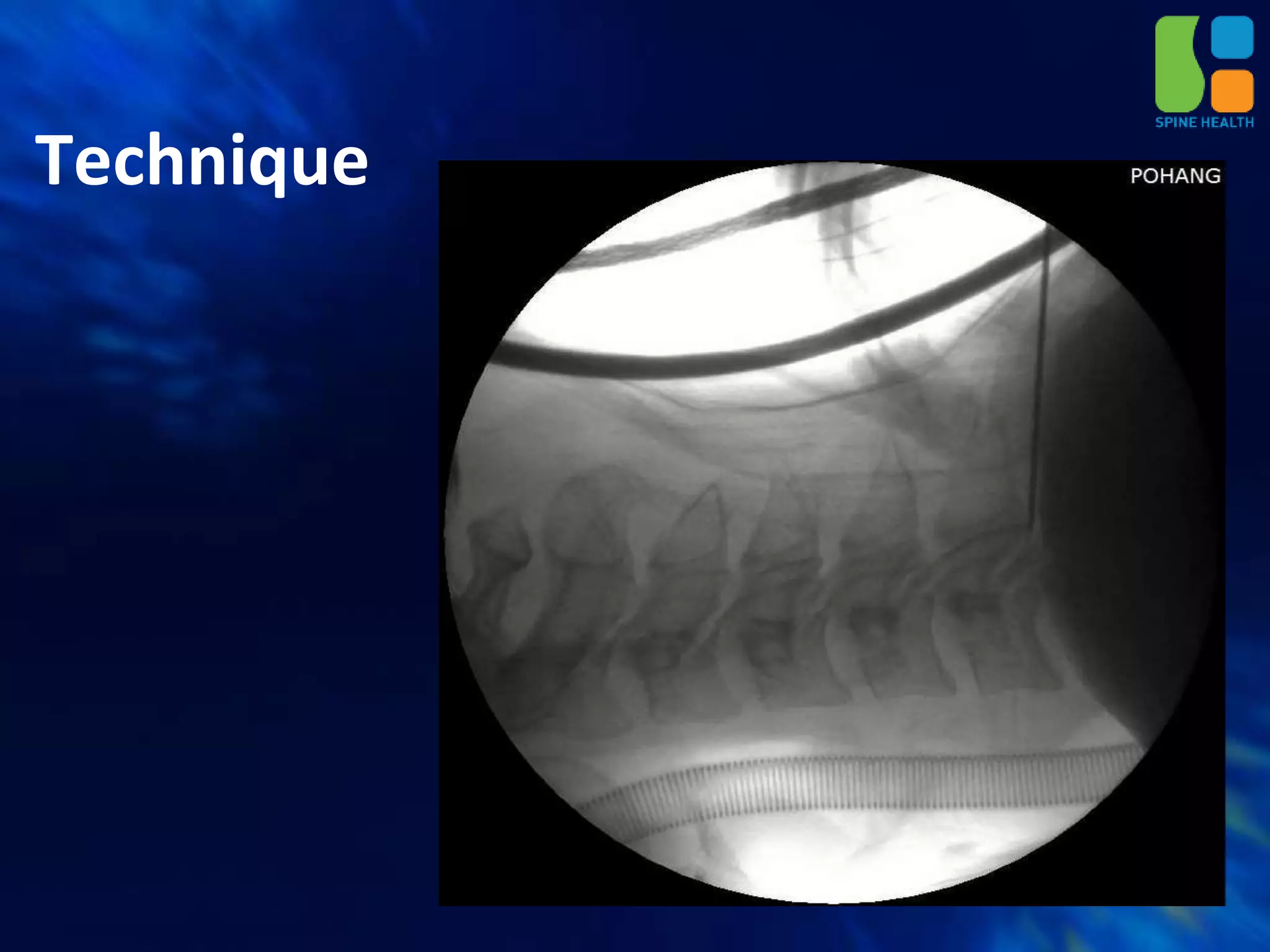 Unilateral Biportal Endoscopic Posterior Cervical Laminectomy and ...