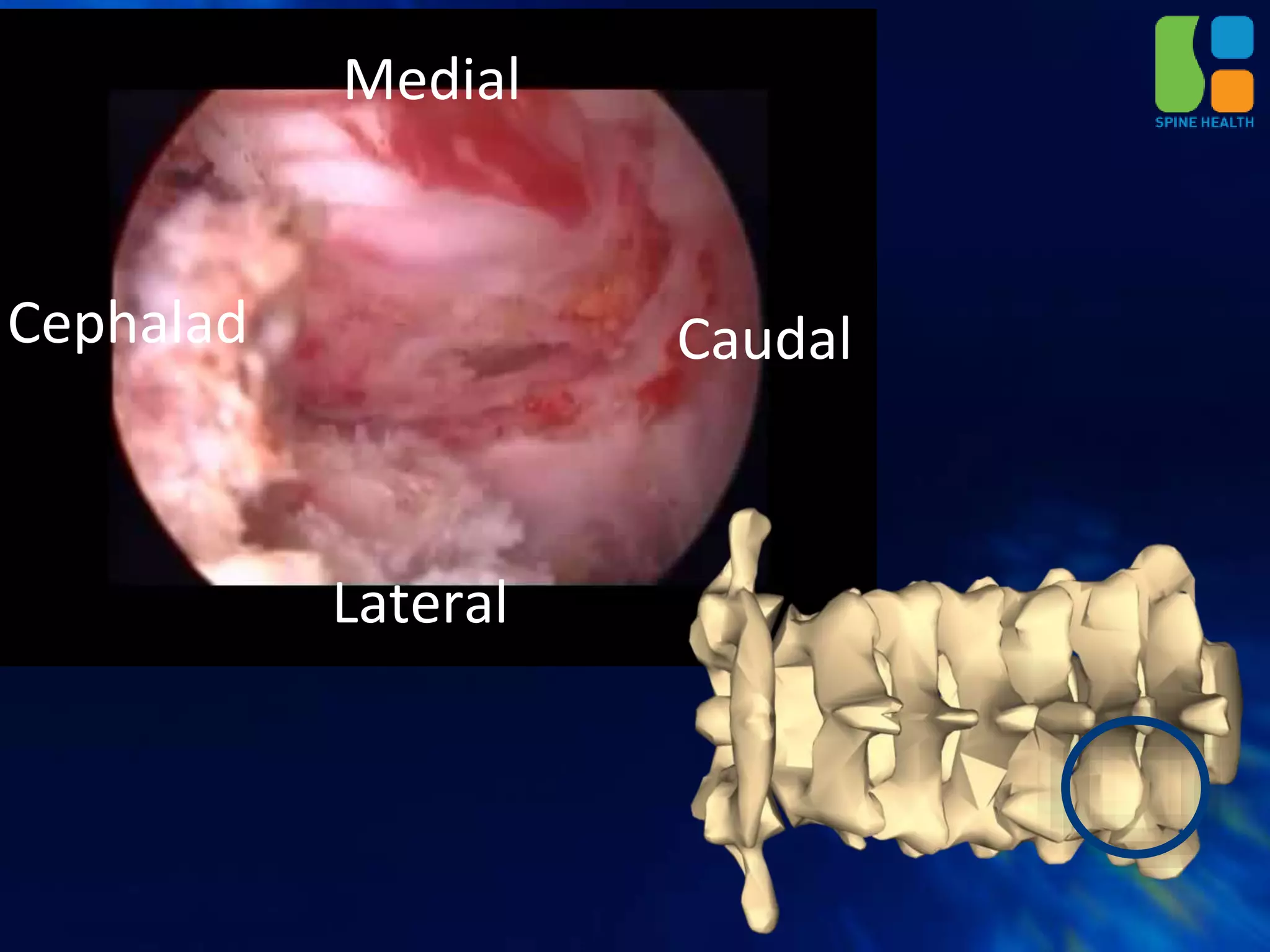 Unilateral Biportal Endoscopic Posterior Cervical Laminectomy and ...