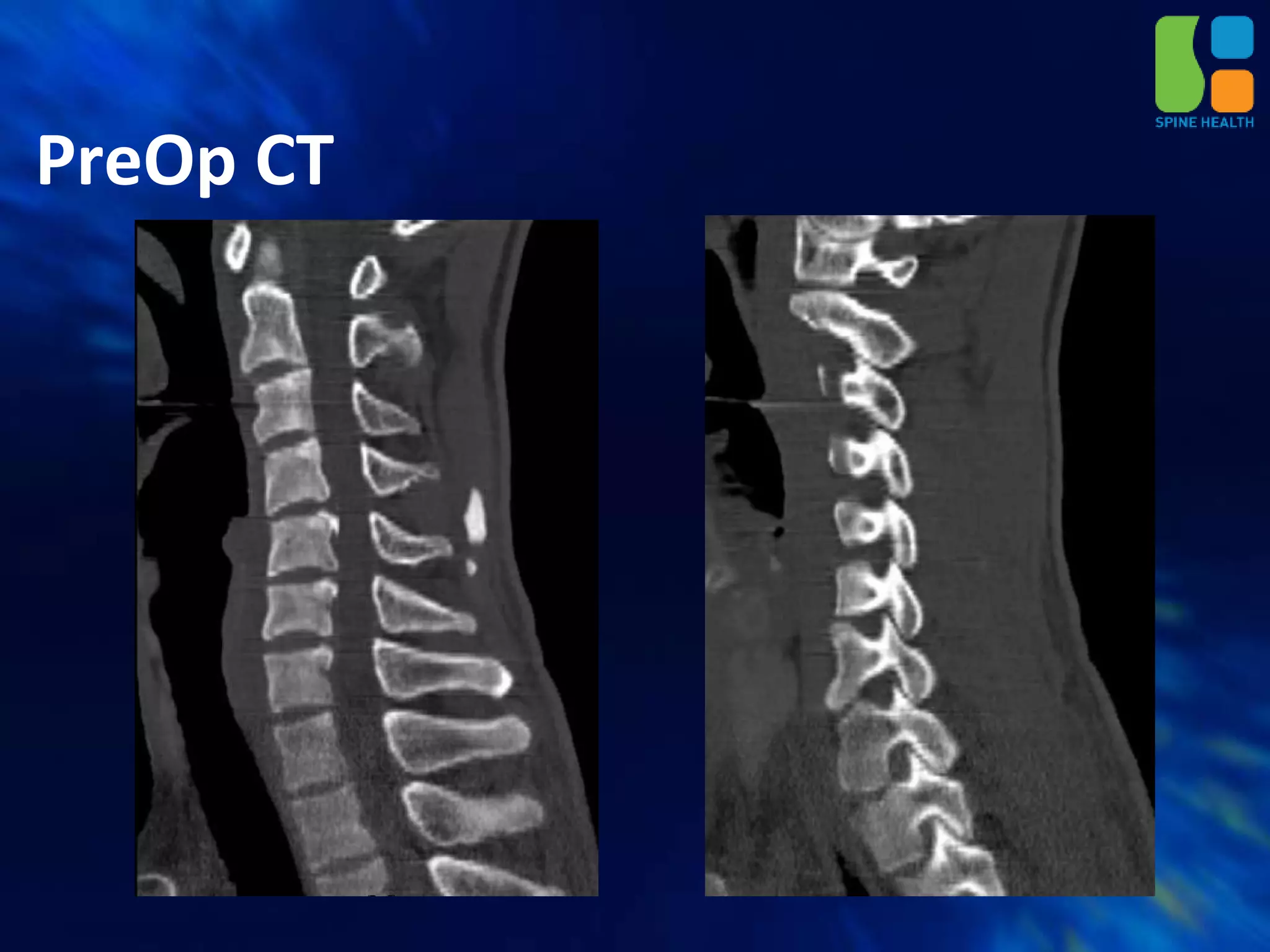 Unilateral Biportal Endoscopic Posterior Cervical Laminectomy and ...