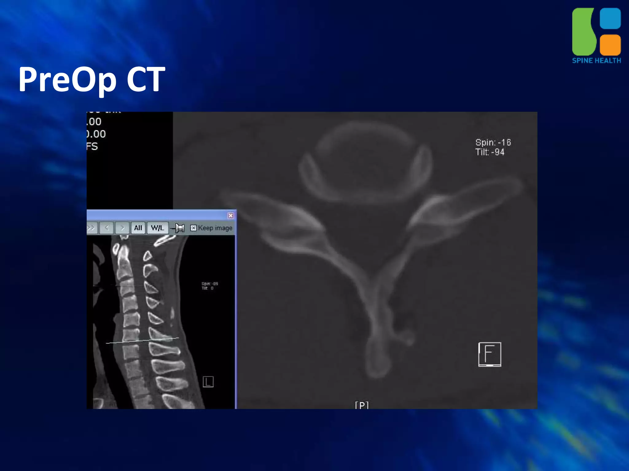 Unilateral Biportal Endoscopic Posterior Cervical Laminectomy and ...