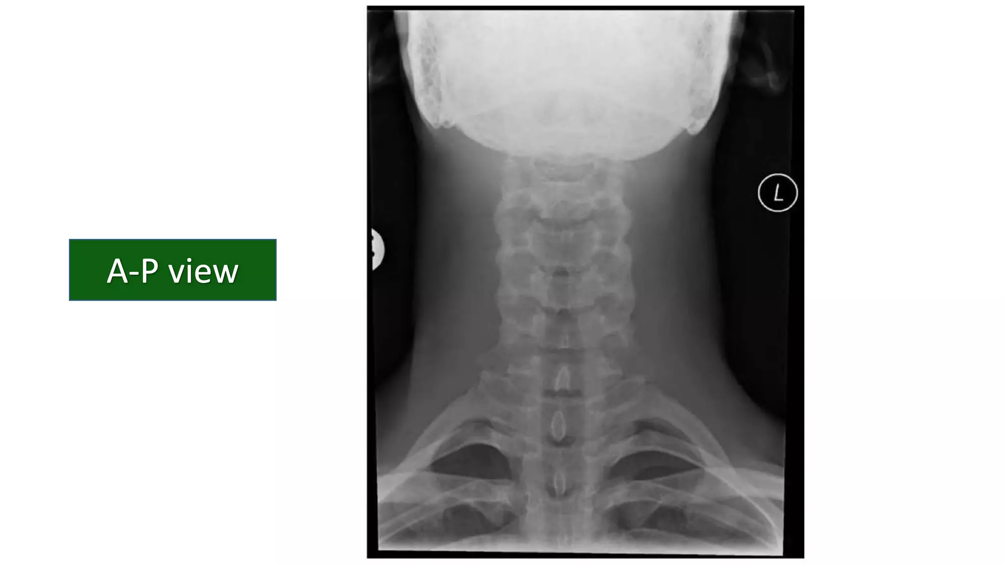 Cervical vertebrae anatomy and pathology | PPTX