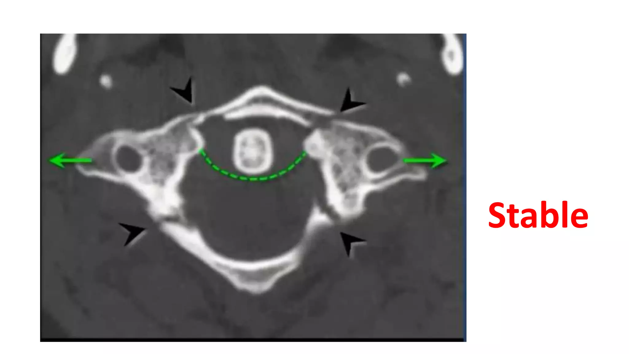 Cervical vertebrae anatomy and pathology | PPTX