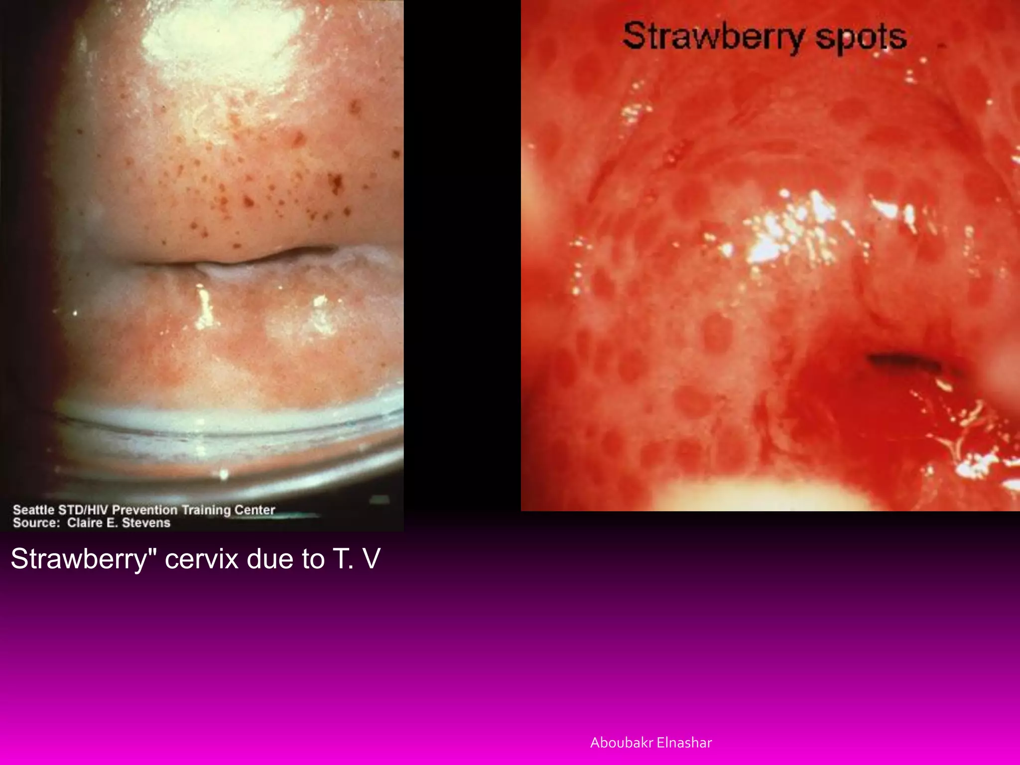 Cervicitis | PDF