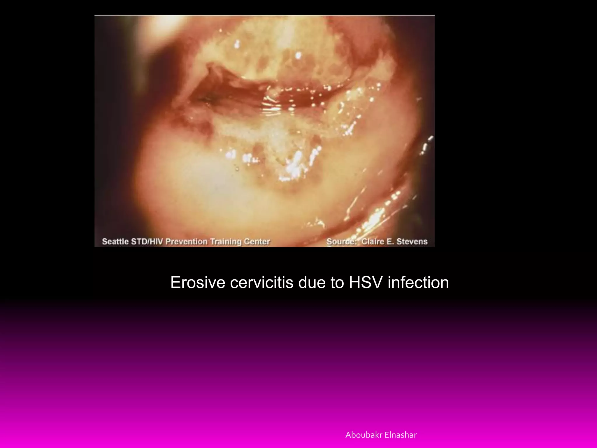 Cervicitis | PDF