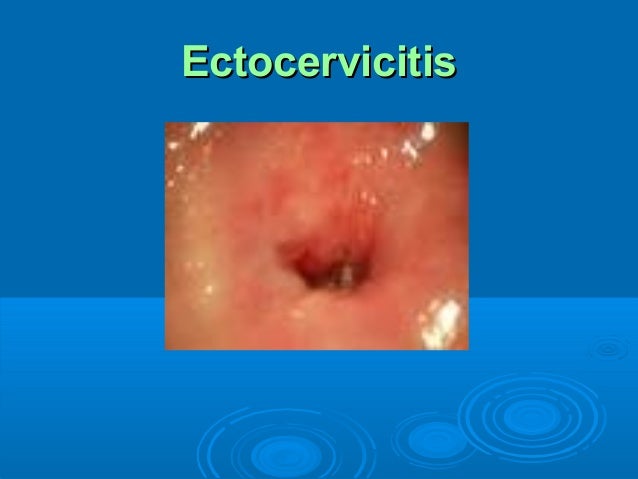 Cervicitis introduccion y descripcion