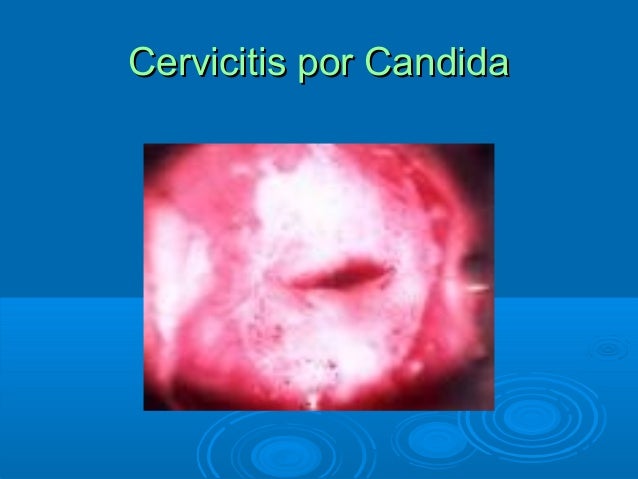 Cervicitis introduccion y descripcion