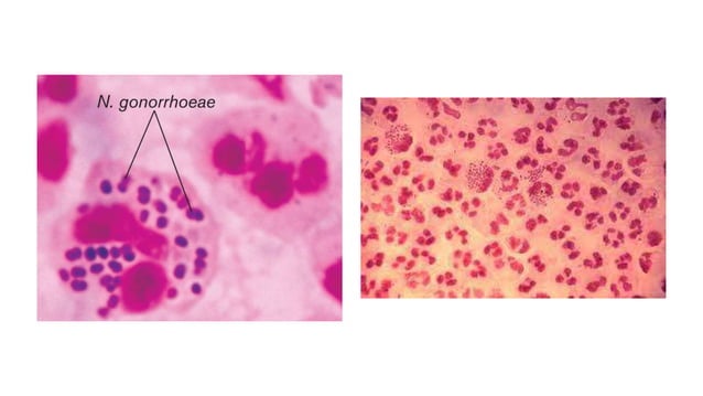Cervicitis.pptx | Sexual Conditions | Sexual Health