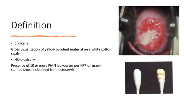 Cervicitis.pptx | Sexual Conditions | Sexual Health
