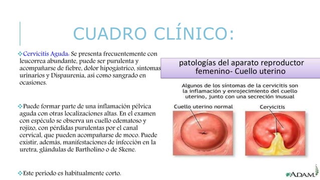 Cervical Erosion Symptoms _ Tooth Erosion: Stages, Causes & Treatment ...