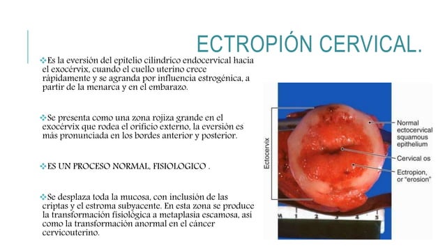 Ectropión Cervical: Que Es, Principales Síntomas Y Tratamiento – IVEWAP