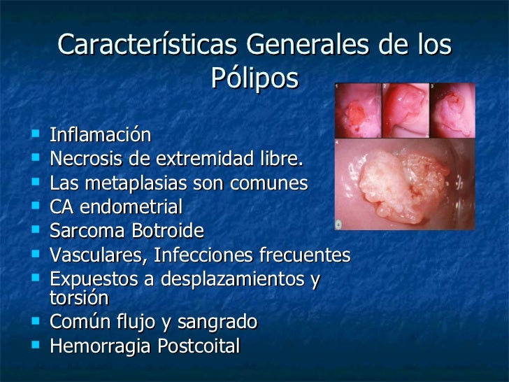 Cervicitis polipos